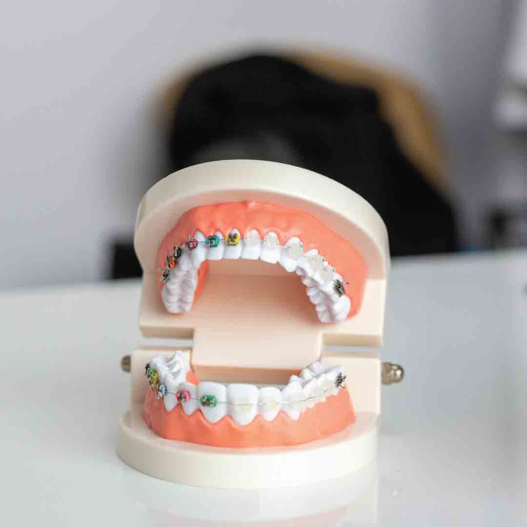 Teeth Braces: Types, Benefits, and Treatment Process – luxury uae